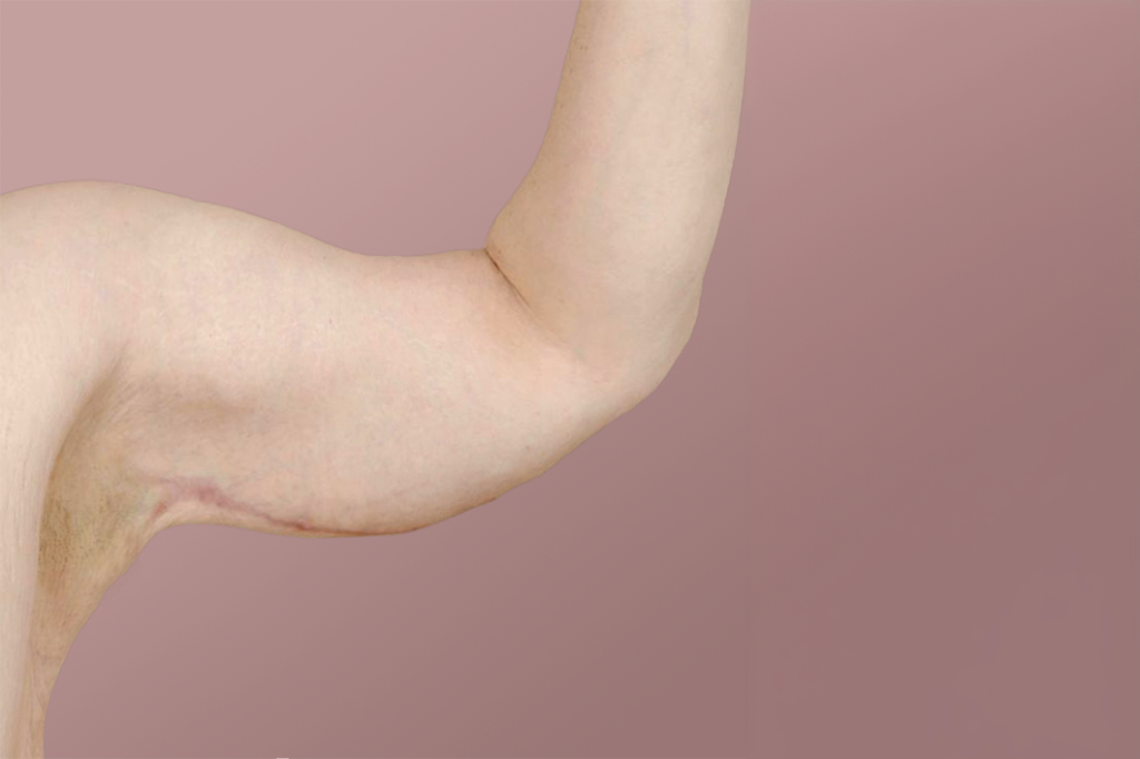 Short Scar Arm Lift - Gulglam Clinics